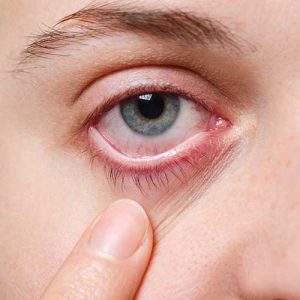 5 Penyakit Mata Yang Sering Terjadi dan Cara Mencegahnya